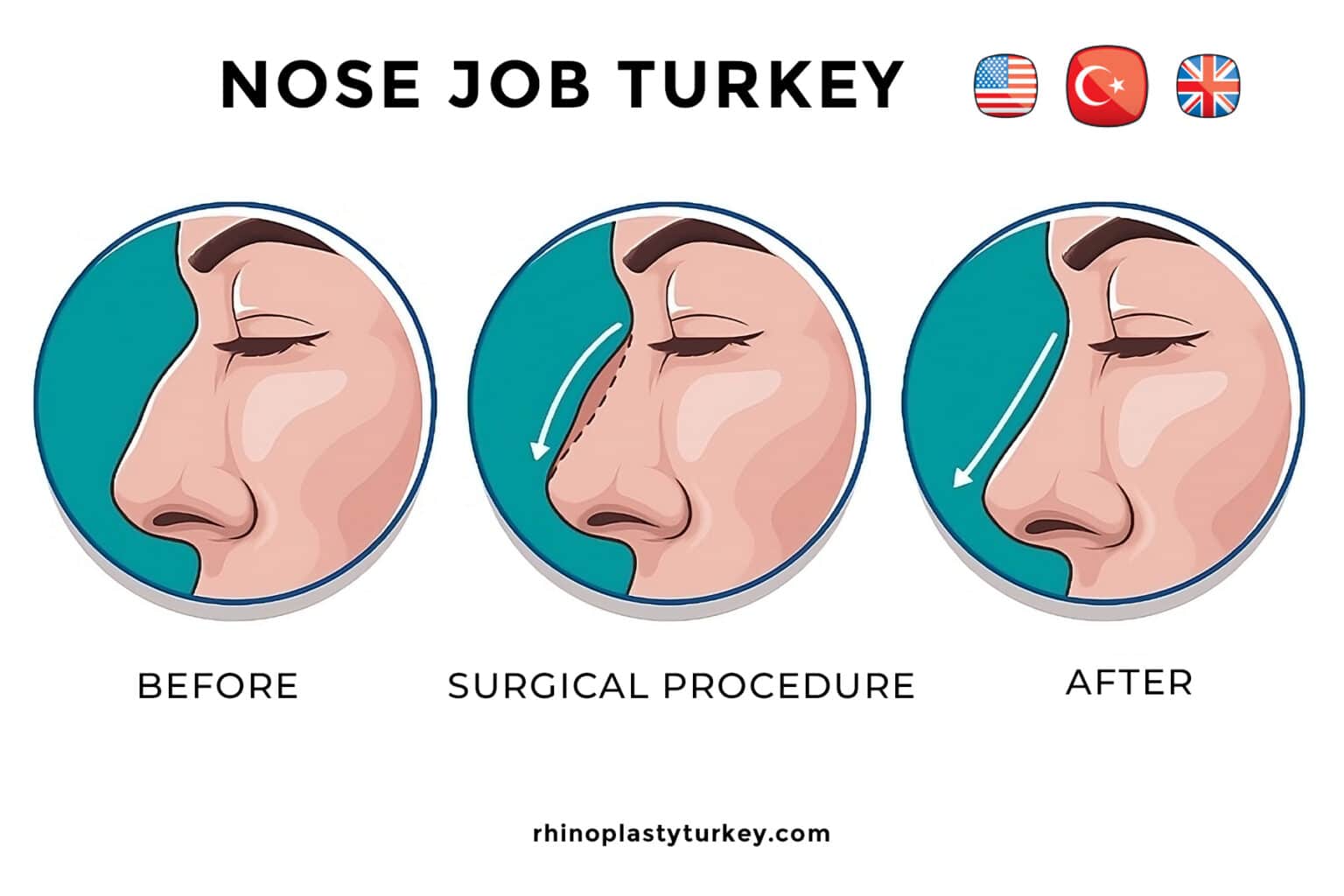 Nose Job Turkey Cost 2025 - Rhinoplasty in Turkey, Istanbul ...